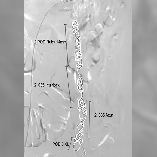 Left Gonadal Vein Embolization | Penumbra Inc